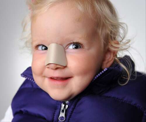 Broken nose is the most common facial fracture