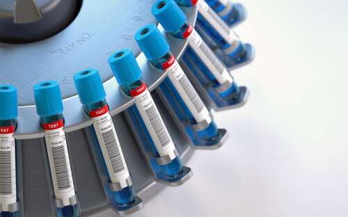 More research needed in promising lupus CAR T-cell therapy